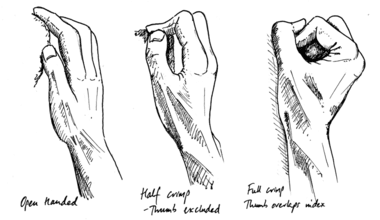 Climbers' hands: injuries, treatment and prevention. Prevention is ...